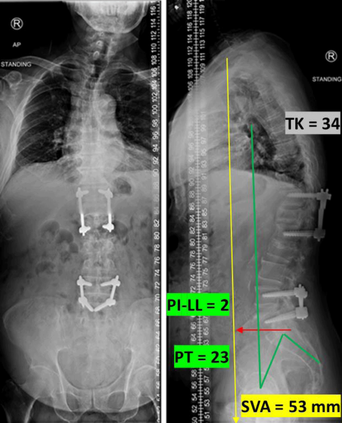 Extension-Distraction Spine Injury at Lumbosacral Junction: A Case Report