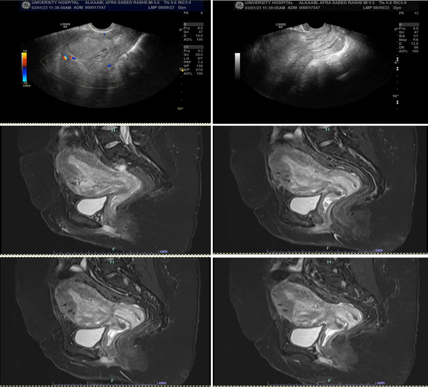 Methotrexate As Conservative Management For Morbidly Adherent Placenta