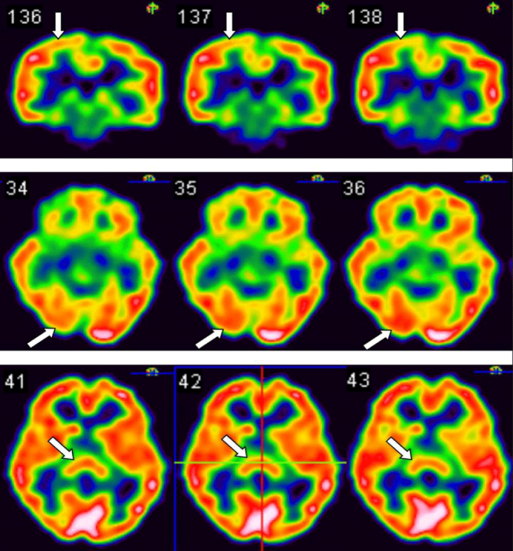 Numbness of the Left Leg Caused by Perfusional Deficit in Right ...